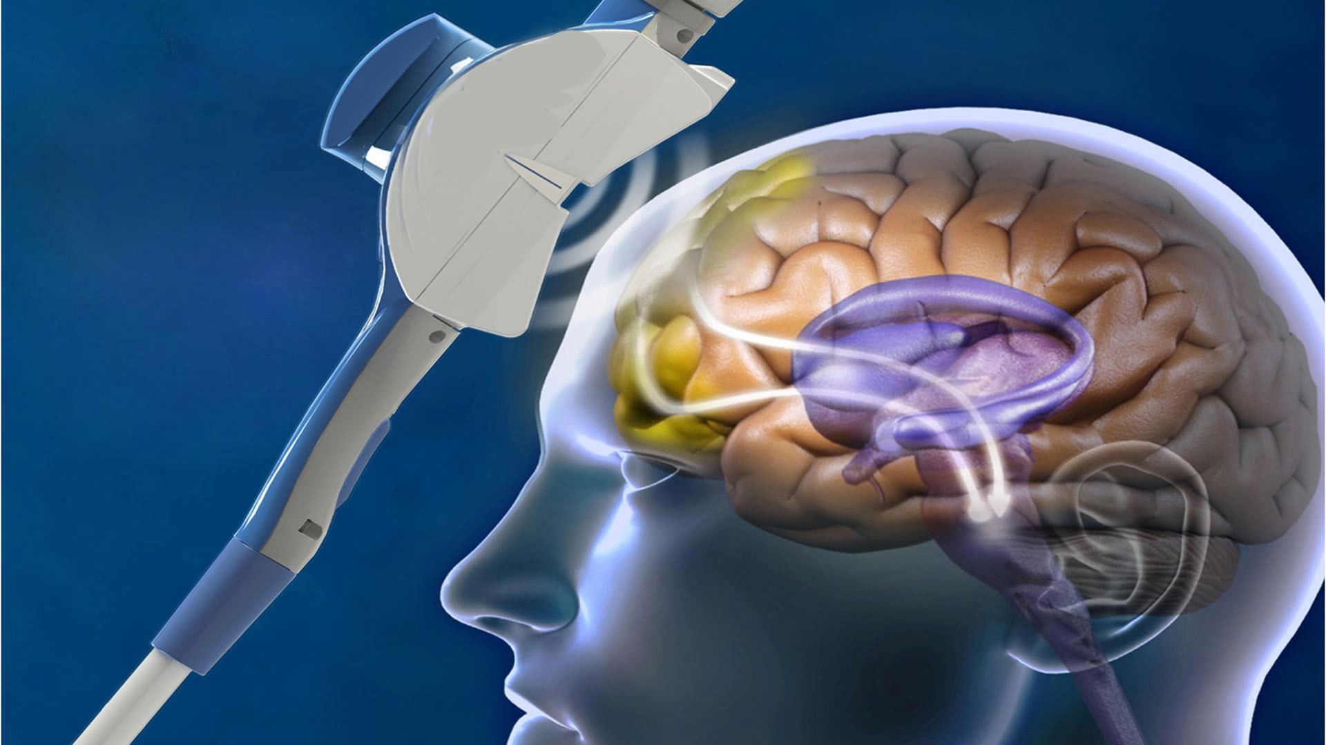 TMS: A Non-Invasive Breakthrough for Treating Depression - Beth Psychiatry
